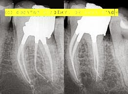 ODONTOS ACADEMY FOR CLINICAL DENTAL STUDIES: Radix Entomolaris and ...