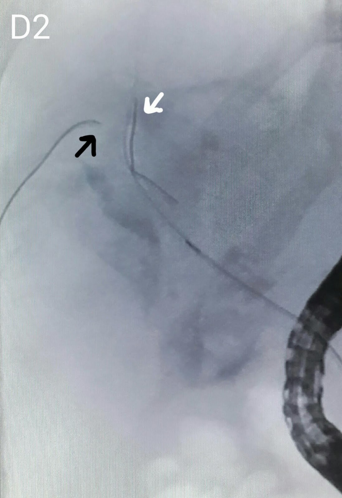 ERCP & EGD : Major biliary tree disruption post surgery
