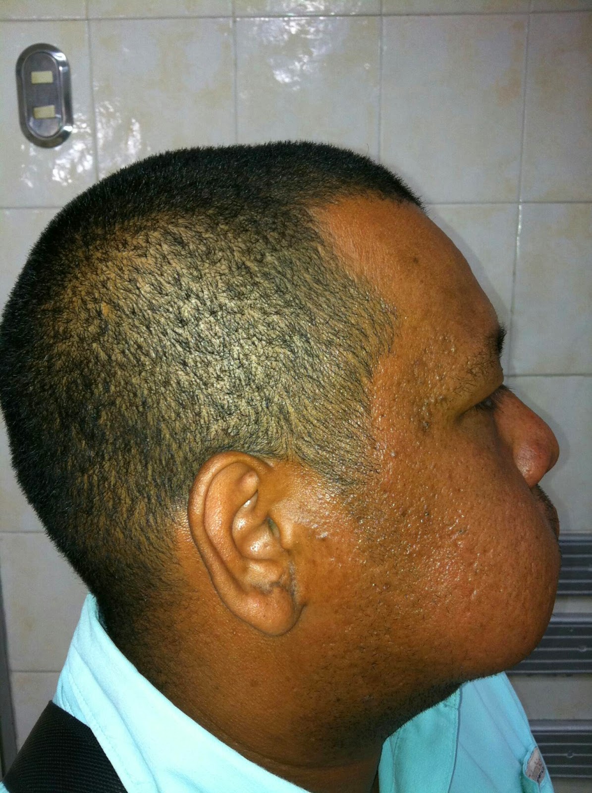 Cohen Cirugia Buco Maxilofacial: Mixoma odontogenico con abordaje weber ...