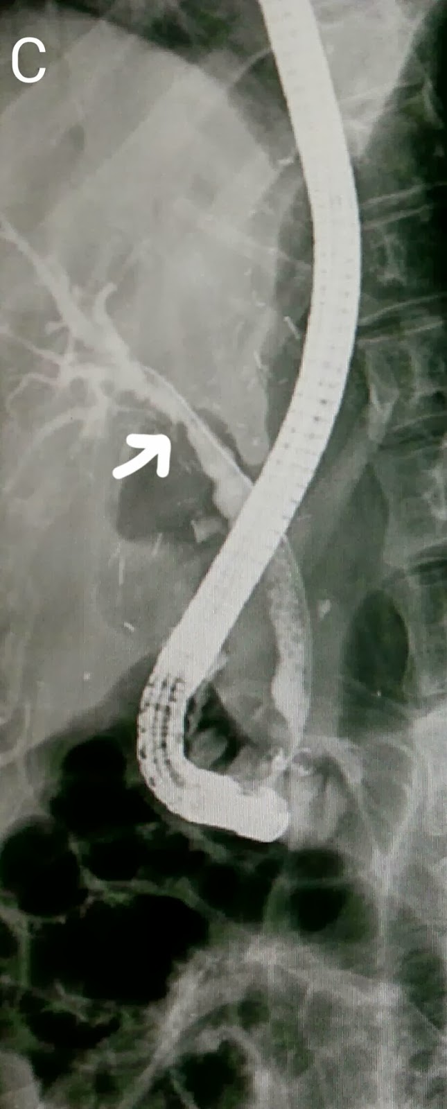 ERCP & EGD : Third follow-up ERCP for post transplant anastomotic ...