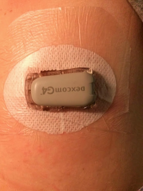 I am a Type 1 Diabetic Warrior: How I tape down my Dexcom G4 to get ...