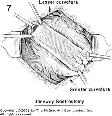 Janeway Gastrostomy Tube