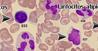 Como identificar linfócitos atípicos | Biomedicina Padrão