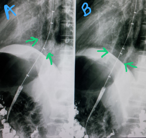 ERCP & EGD : Achalasia of the cardia in a 52 year old gentleman
