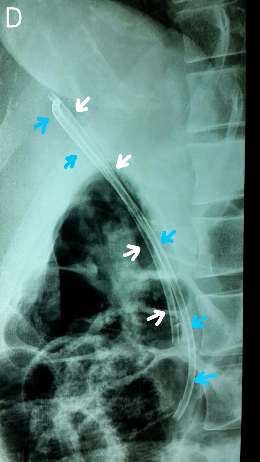 ERCP & EGD : Fifth follow up ERCP for post cholecystectomy biliary ...