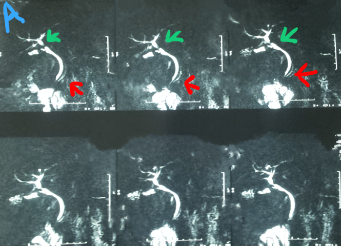 ERCP & EGD : When ERCP and MRCP differ