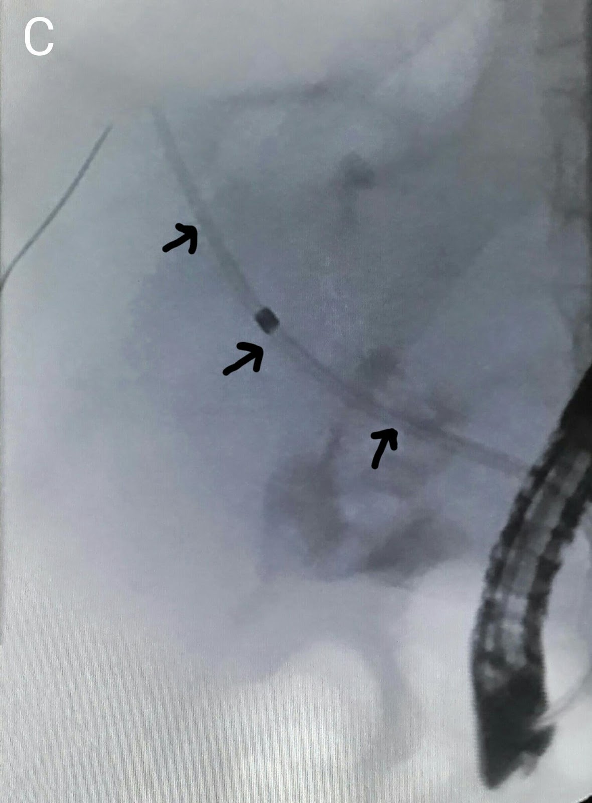 ERCP & EGD : Major biliary tree disruption post surgery