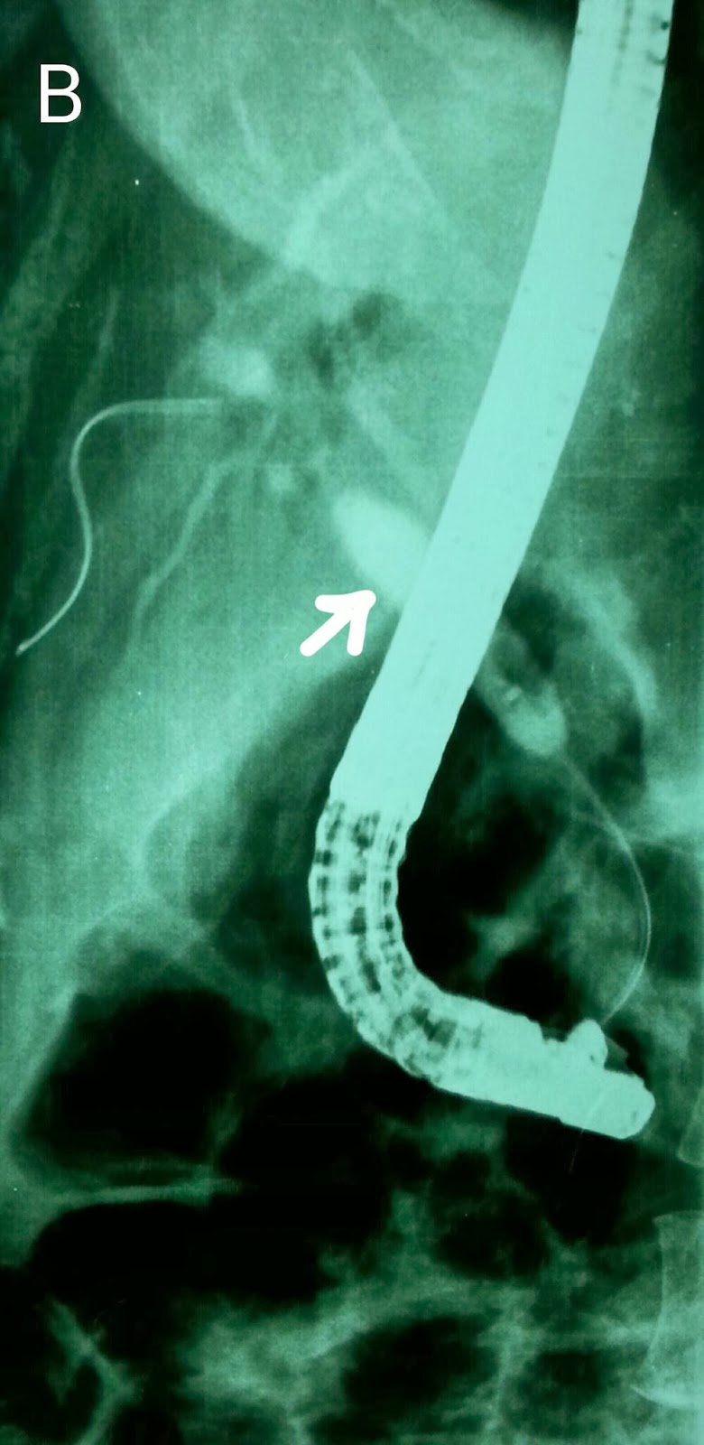 ERCP & EGD : Fourth follow up ERCP for a post cholecystectomy CBD stricture