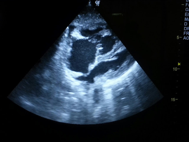 NEELZ ON WHEELZ: COR PULMONALE .dilated RA RV, pulmonary regurgitation ...