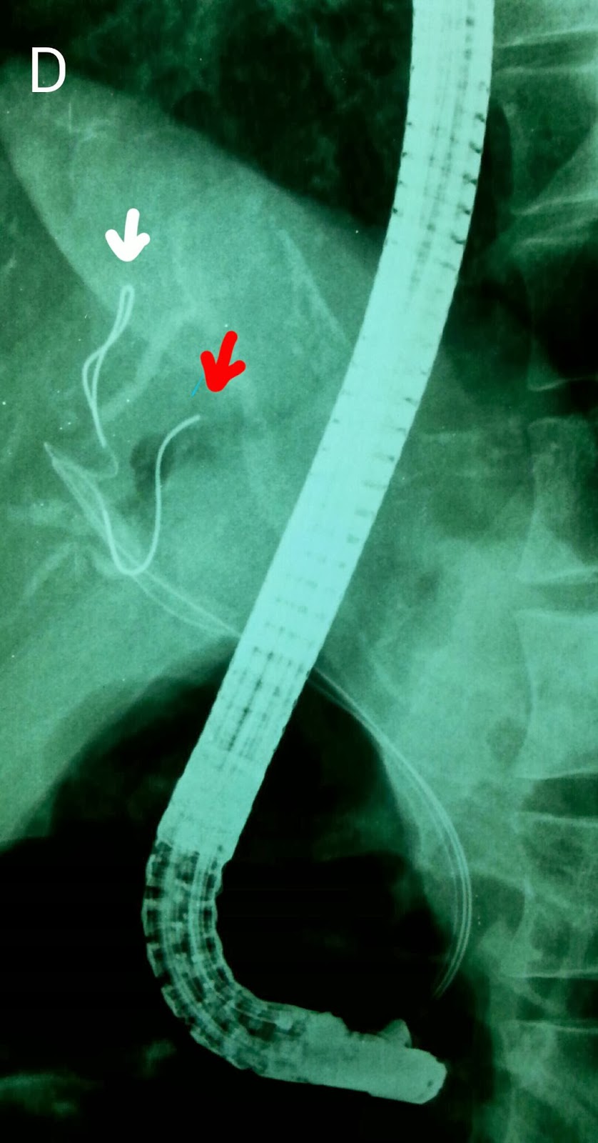 ERCP & EGD : Fourth follow up ERCP for a post cholecystectomy CBD stricture