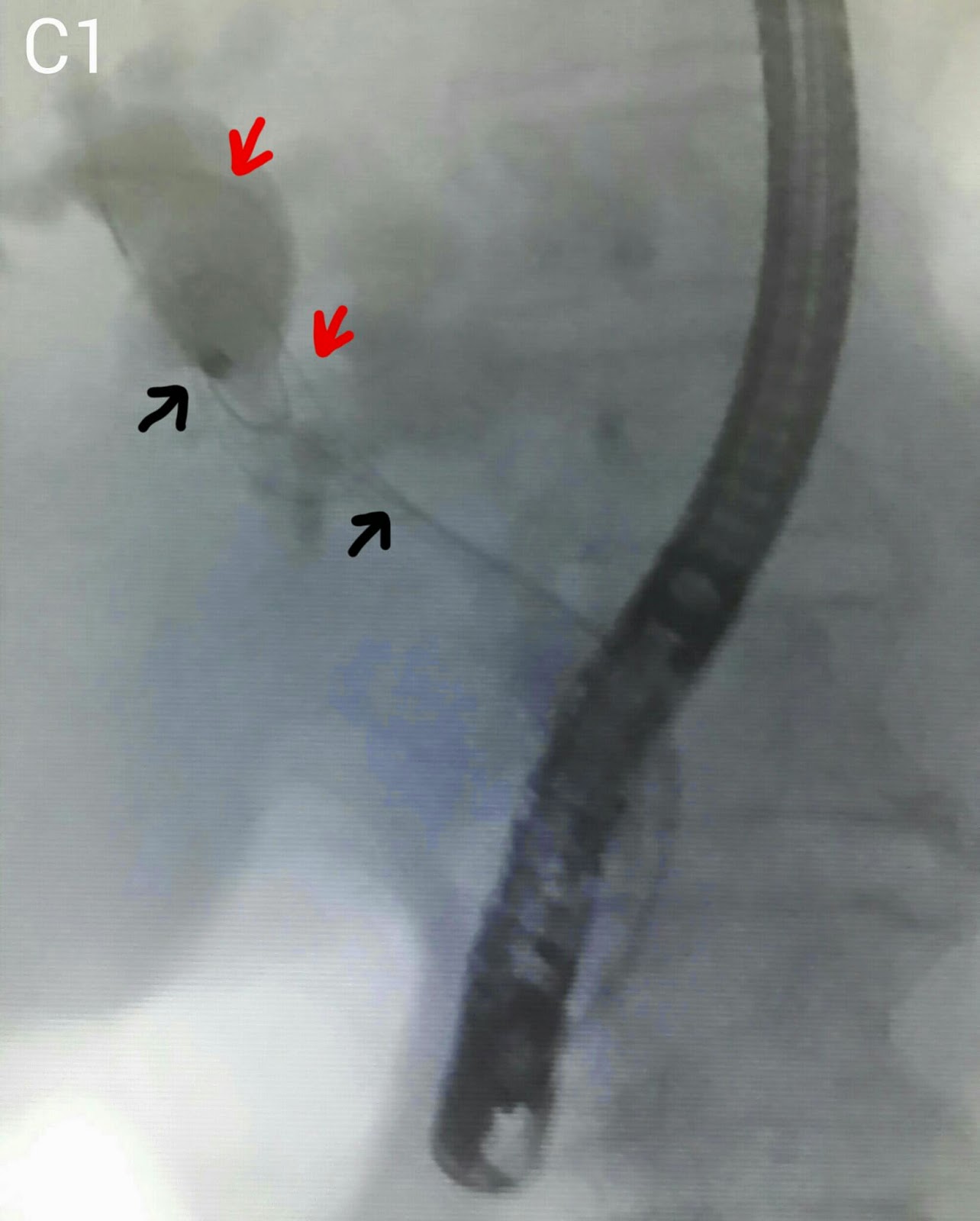 ERCP & EGD : Managing a hilar stricture (or trying to, at least)