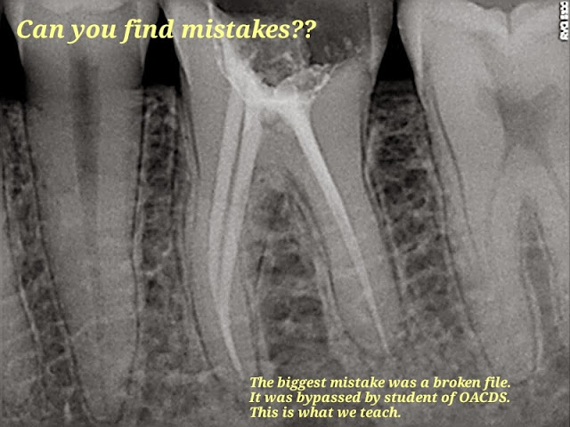 ODONTOS ACADEMY FOR CLINICAL DENTAL STUDIES: How to bypass a broken K ...