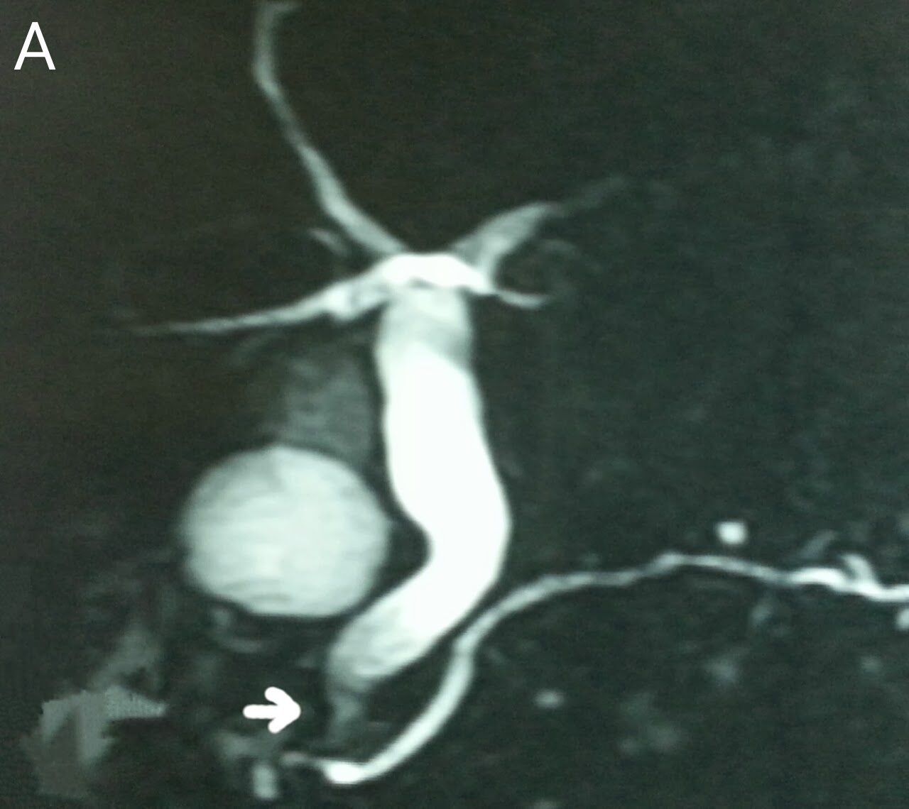 ERCP & EGD : Diverticula Galore!
