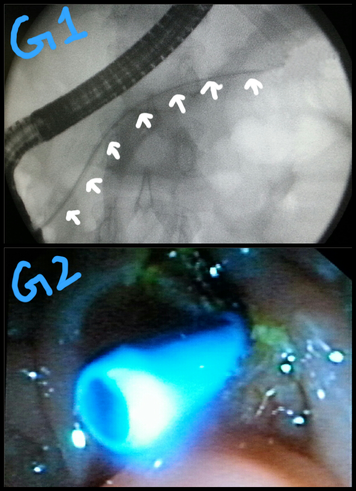 ERCP & EGD : Managing choledocholithiasis and a damaged pancreatic duct ...
