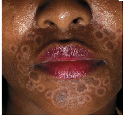 Magonjwa ya Zinaa - KAKYTEE MEDIA