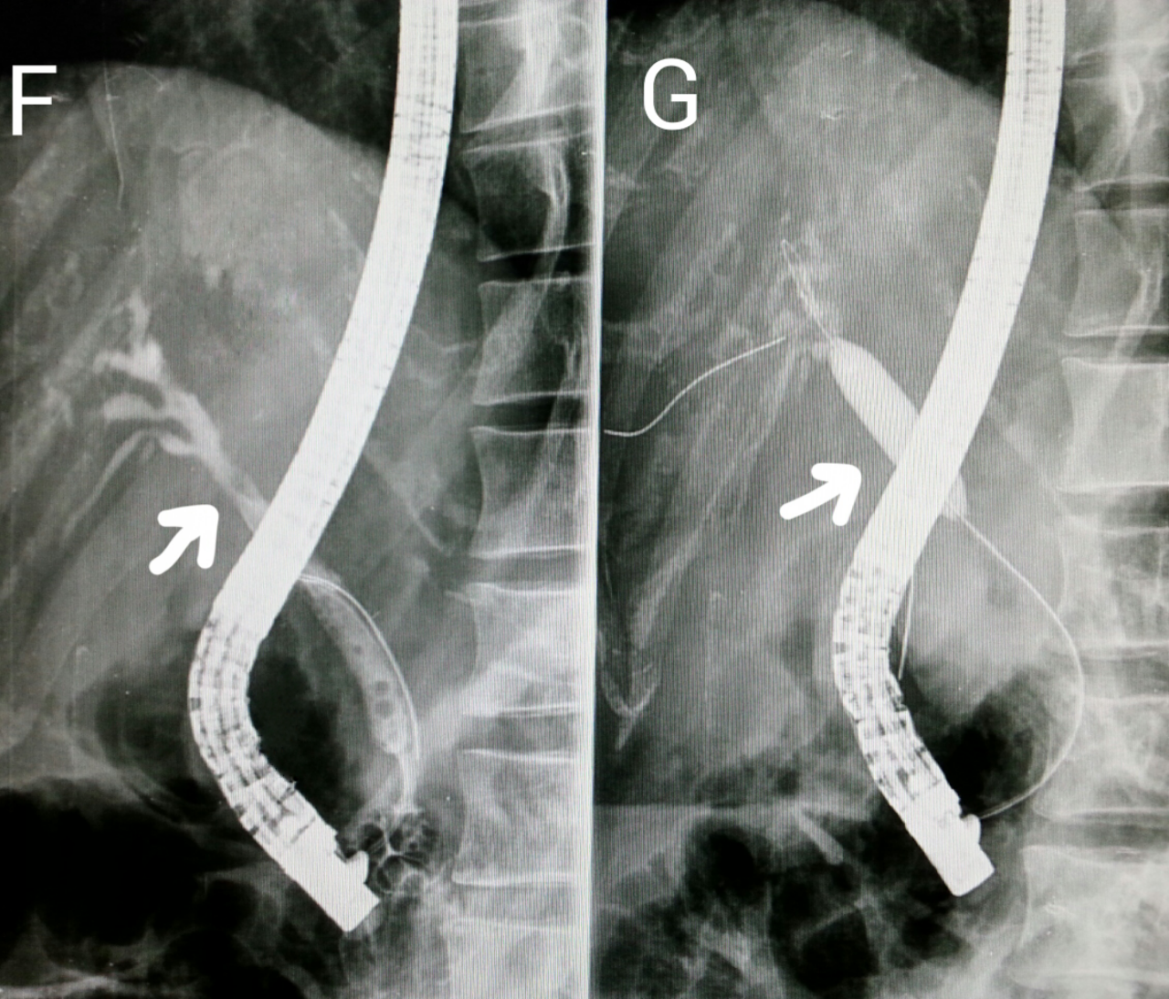 ERCP & EGD : Follow up case of post cholecystectomy biliary stricture