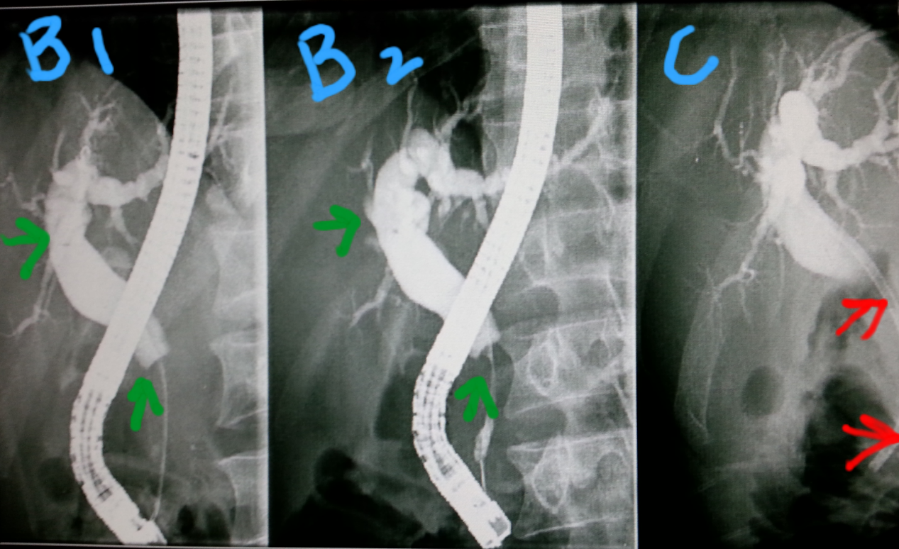 ERCP & EGD : Carcinoma of pancreatic head causing obstructive jaundice