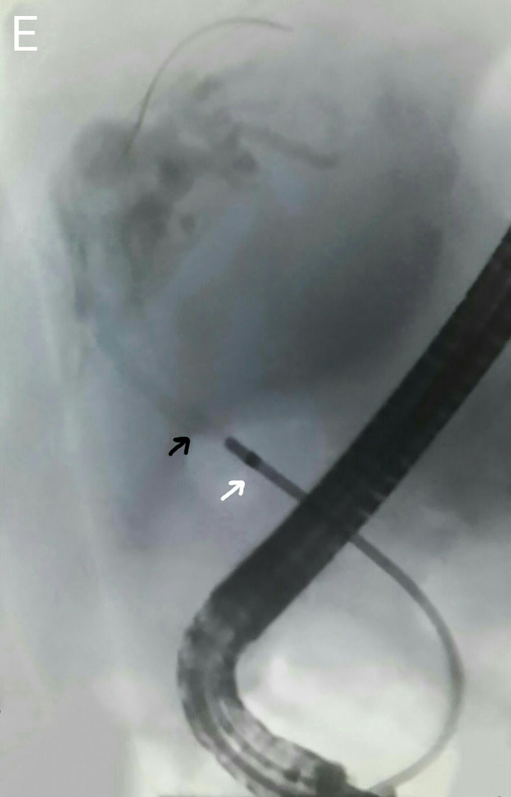 ERCP & EGD : Migrated biliary stent