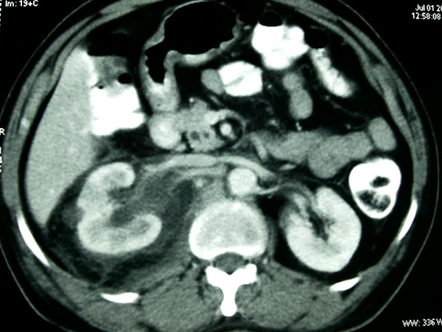 RADIOLOGY IMAGE SPOTTERS: Urinoma ct kub