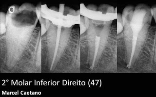 Endodontia Avançada: Segundos Molares Inferiores com anatomia atípica ...