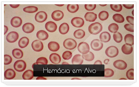 Alteração morfológica das hemácias | Biomedicina Padrão