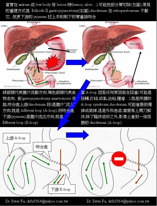 急症外傷外科的大小事...我的理想,抱負與信念: A-loop syndrome (1)