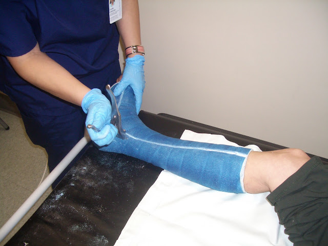 Documenting My Posterior Tibial Tendon Surgery and Recovery: Next Phase ...