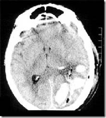 PERDARAHAN INTRA KRANIAL ~ Seputar Kedokteran
