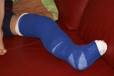 schlossWeb » Update Gipsbein