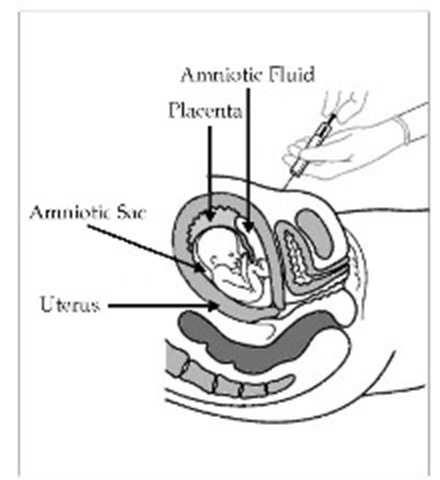 Amniocentesis Diagram