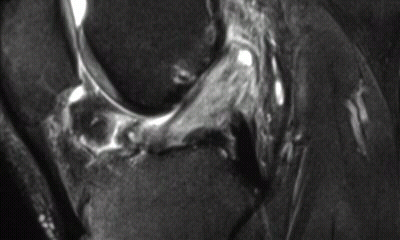 Daily Dose: ACL mucoid degeneration