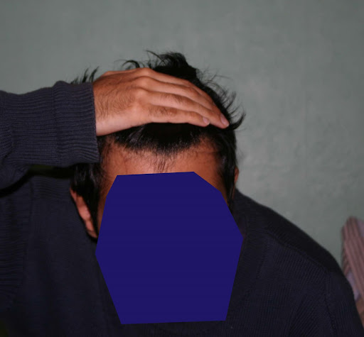 Went from NW1 to NW2 in 4 months | HairLossTalk Forums